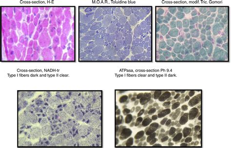 Congenital Fiber Type Disproportion Myopathy A Case Study Medicina