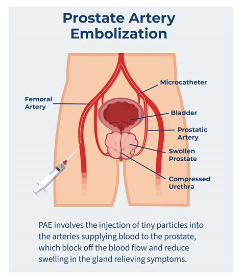 Prostate Artery Embolization Pae Treatment Uvvc