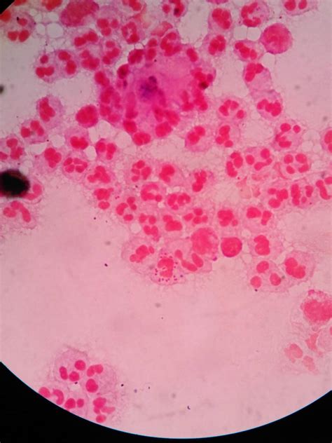 Vaginal Discharge With Intracellular Diplococci Gonococci Scrolller