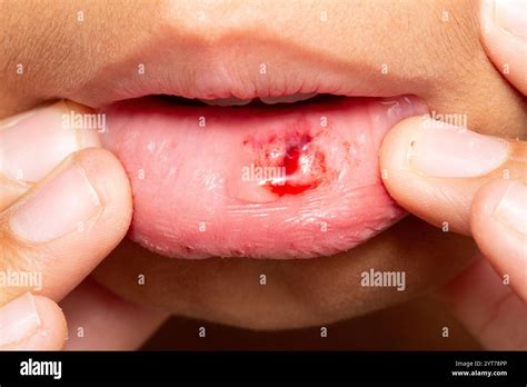Close Up Of A Womans Mouth Showing Bleeding Wound Inside Lower Lip
