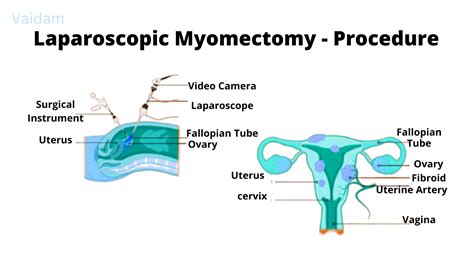Fibroids Laparoscopic Myomectomy At Lois Lumpkin Blog