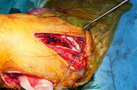 Congenital Hip Dislocation Surgery Stock Image C0114332 Science