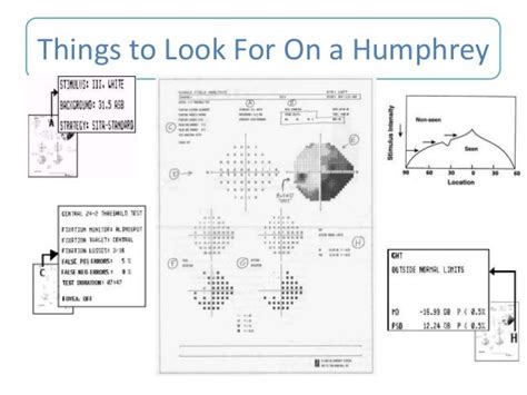 Interpreting Visual Fields