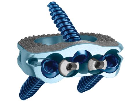 Interbody Spacers Archives Globus Medical