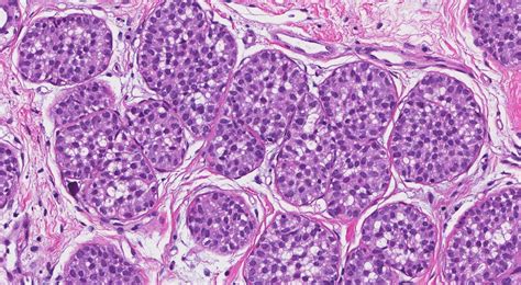 Health Lines Lobular Carcinoma Anatomy Classification Epidemiology
