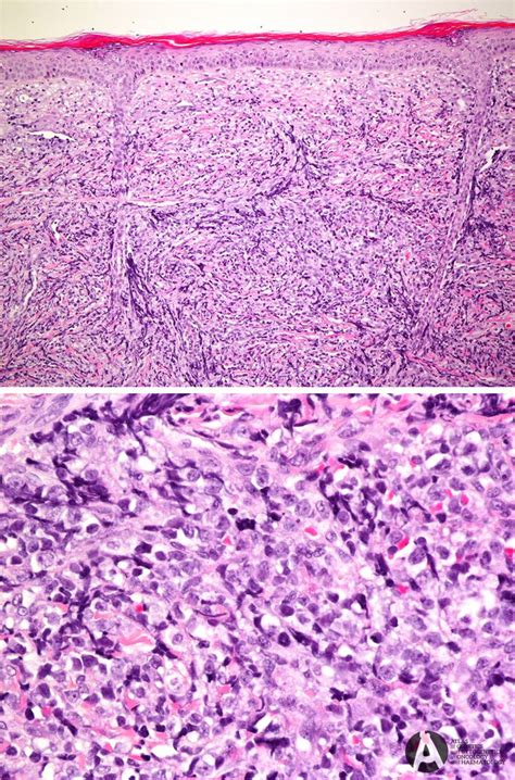 Myeloid Sarcoma