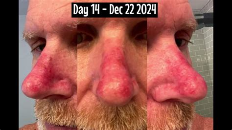 Efudex Treatment On Nose Before During And After Pics Youtube