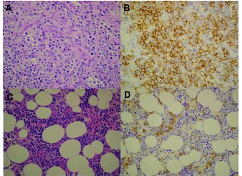 Histopathology Of Lymph Node And Bone Marrow Tissues A In Lymph Node
