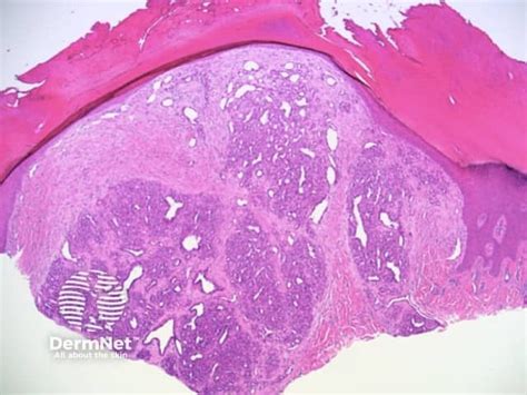 Pyogenic Granuloma