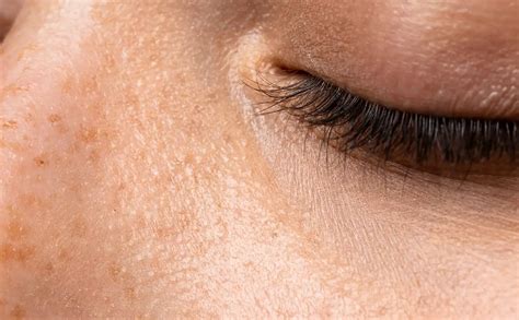 Milia Removal In Dubai Safe And Effective Treatment