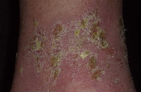Stasis Dermatitis On Legs Pictures 174 Photos And Images