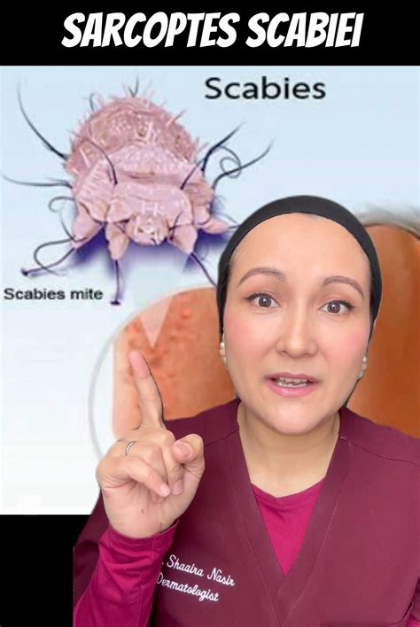 Scabies Recent Outbreak In Uk Wash All Bedding And Clothing At 60c Or Higher And If Possible