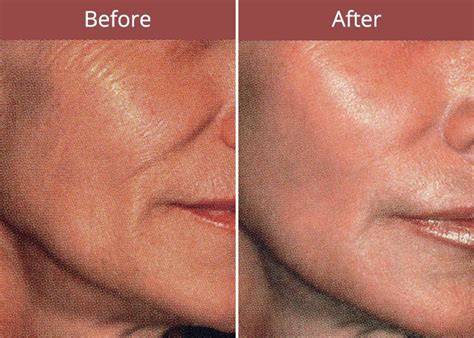 Glycolic Peel Before And After Photos At David Dodd Blog
