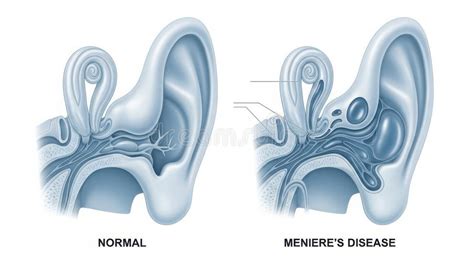 Comparison Of Normal Inner Ear Anatomy Versus Meniere S Disease Ear Structure Illustration Stock