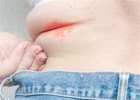 Intertrigo Rash Intertrigo Rash Under Elderly Womans Breast Stock