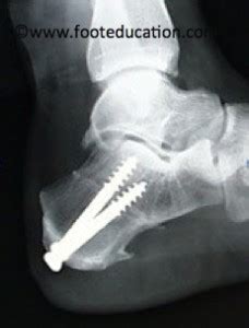 Calcaneal Osteotomy Footeducation
