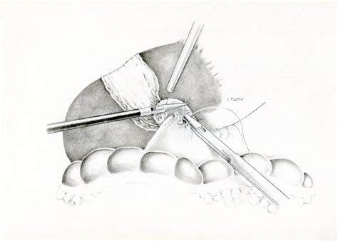 Coledocoduodenostomía Archives Dr Javier Martín Delgado