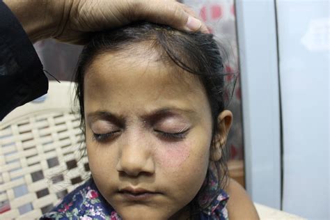 Full Recovery In Case Of Abcd Airborne Contact Dermatitis And Phrenoderma With Homeopathy