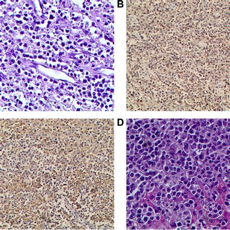 Marsh Oberhuber Classification Of Celiac Disease Download Table