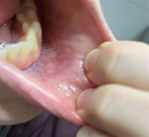Bump On Lip Raskdentists
