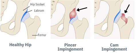 Understanding Hip Impingement Causes Symptoms And Treatment Options