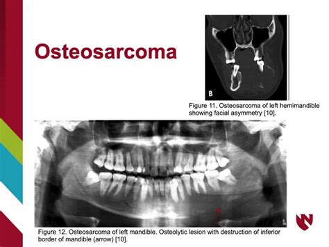 Osteoblastoma Jaw Imaging Approach For Jaw And Maxillofacial Bone