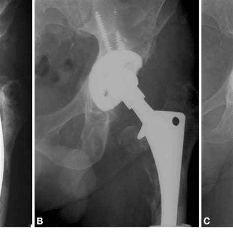 The Standard Corail Stem Collar Option Download Scientific Diagram