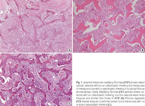 Cemento Osseous Dysplasia Histology