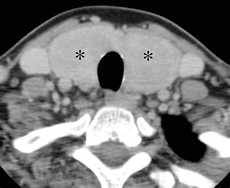 Ct Of The Neck Image Analysis And Reporting In The Emergency Setting