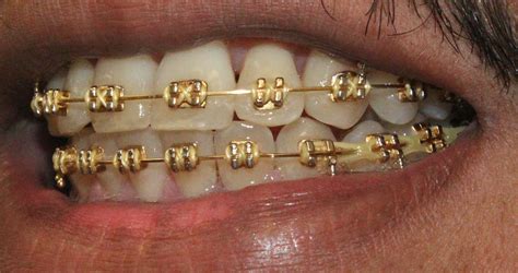 Gold Orthodontic Retainers