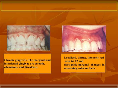 Clinical Features Of Gingivitisppt