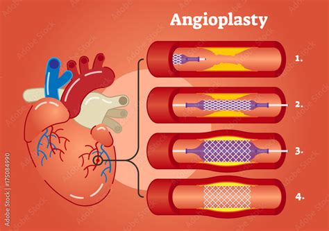 Angioplasty Illustration Illustrated Scheme Showing Angioplasty Concept In 4 Steps Stock