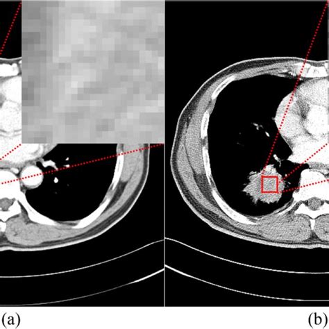 An Example A Lung Ct Comparing The Tumor Texture For Two Different
