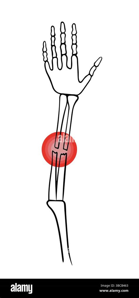 Vector Isolated Illustration Of A Closed Forearm Fracture Outline