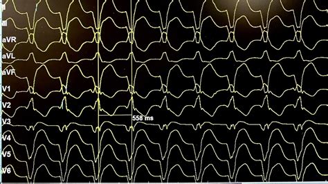 Tarv Dhanjal On Linkedin Todays Vt Storm Incessant Vt Despite Amiodarone Lidocaine And Tpw