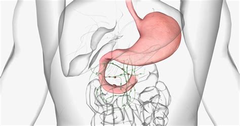 Stage Iii Adenocarcinoma In Duodenum Premium Photo
