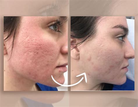 Dermapen Pro Age Clinic Uae