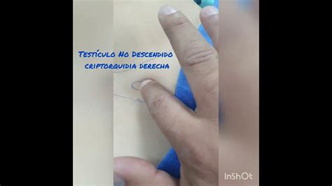 Testículo No Descendido Criptorquídia Derecha Youtube
