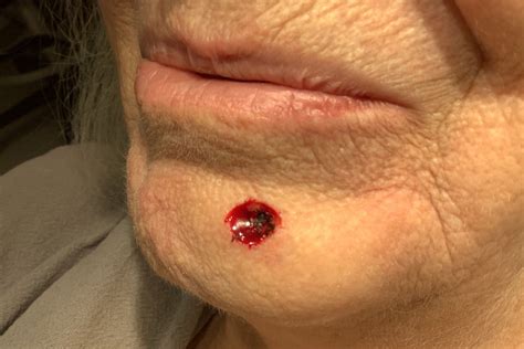 Mohs Surgery Procedure Gallery Baucom And Mina Derm Surgery Llc