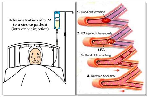 T Pa A Magic Bullet For Treating Stroke