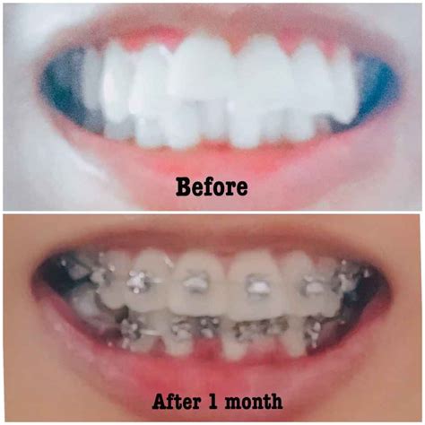Pengalaman Pakai Braces And Kos Yang Perlu Dibayar 2021 Ree Aki