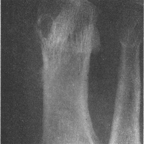 Pdf Thyroid Acropachy