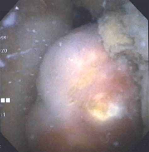 Rapid Prostatic Regrowth And A Free Floating Necrotic Bladder Mass