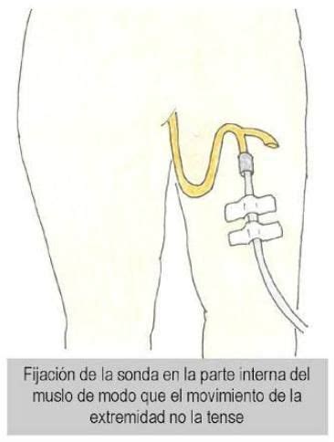 Fijación De La Sonda Vesical Tecnico Auxiliar De Enfermeria Teorias
