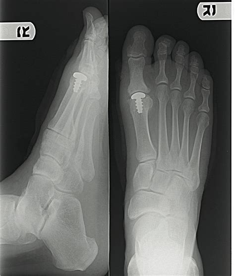 Hallux Rigidus Cheilectomy
