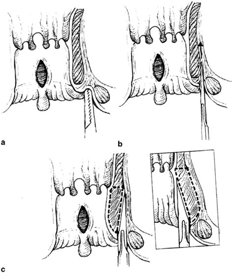 Incontinence After Lateral Internal Sphincterotomyfistulotomy