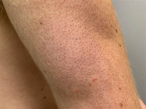 Understanding The Skin Condition Keratosis Pilaris