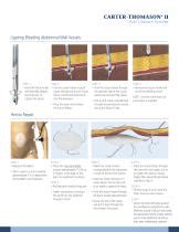 Carter Thomason Ii Port Site Closure System Coopersurgical Pdf