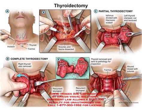 Amicus Illustration Of Amicussurgerythroidectomythyroidincision