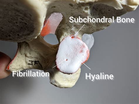 Facet Joint Syndrome Review And Models